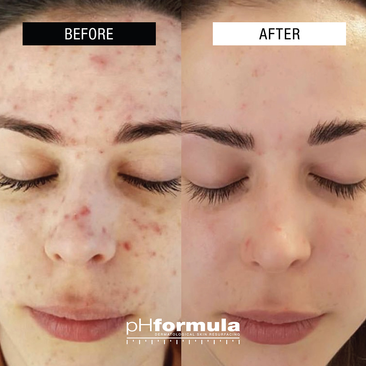 Treating Adult Acne - pHformula Africa